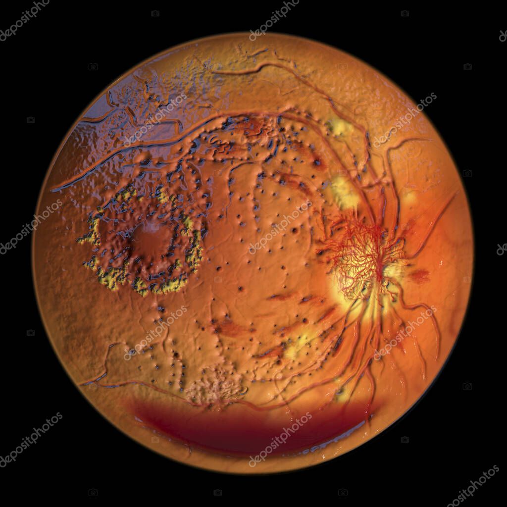 La retinopatía diabética proliferativa, ilustración 3D muestra ...