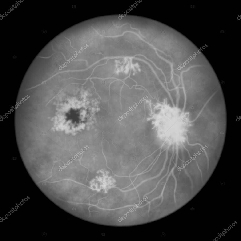 Retinopatía diabética proliferativa, ilustración que muestra ...
