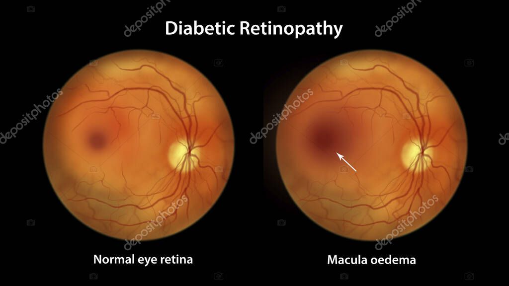 Diabetic macular edema (DME), illustration showing normal eye retina ...