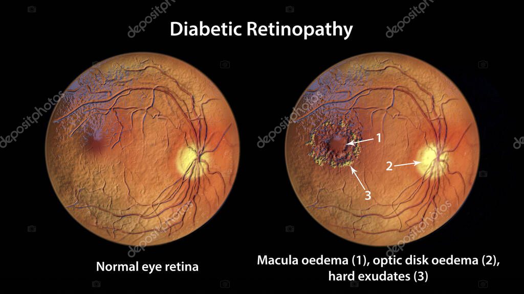 Diabetic retinopathy, 3D illustration showing macula edema, optic disk ...