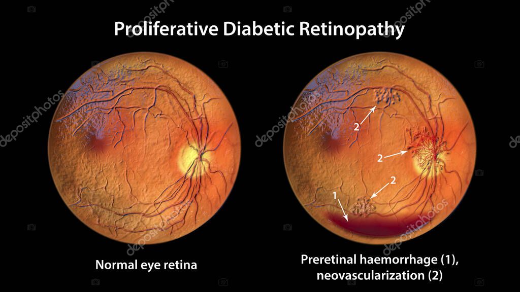 Fotos de Proliferative Diabetic Retinopathy Illustration Showing ...