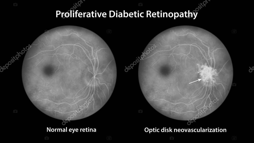 Proliferative diabetic retinopathy, illustration showing ...