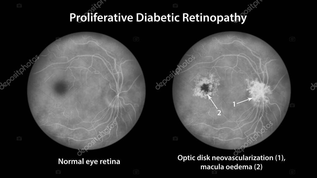 Retinopatía diabética proliferativa, ilustración que muestra ...