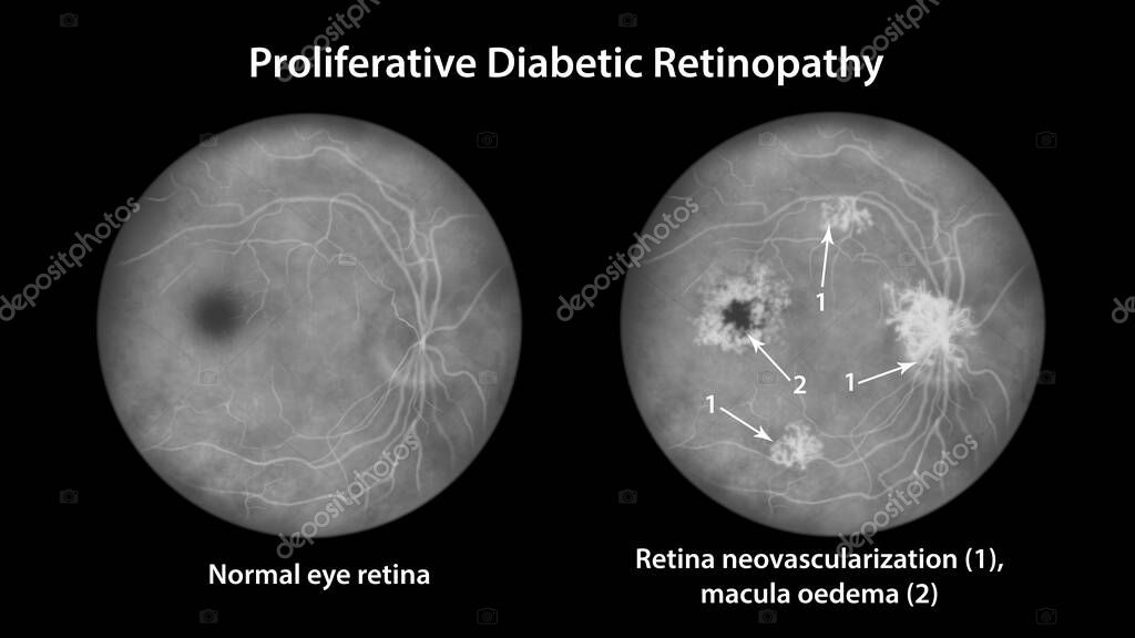 Retinopatía diabética proliferativa, ilustración que muestra ...