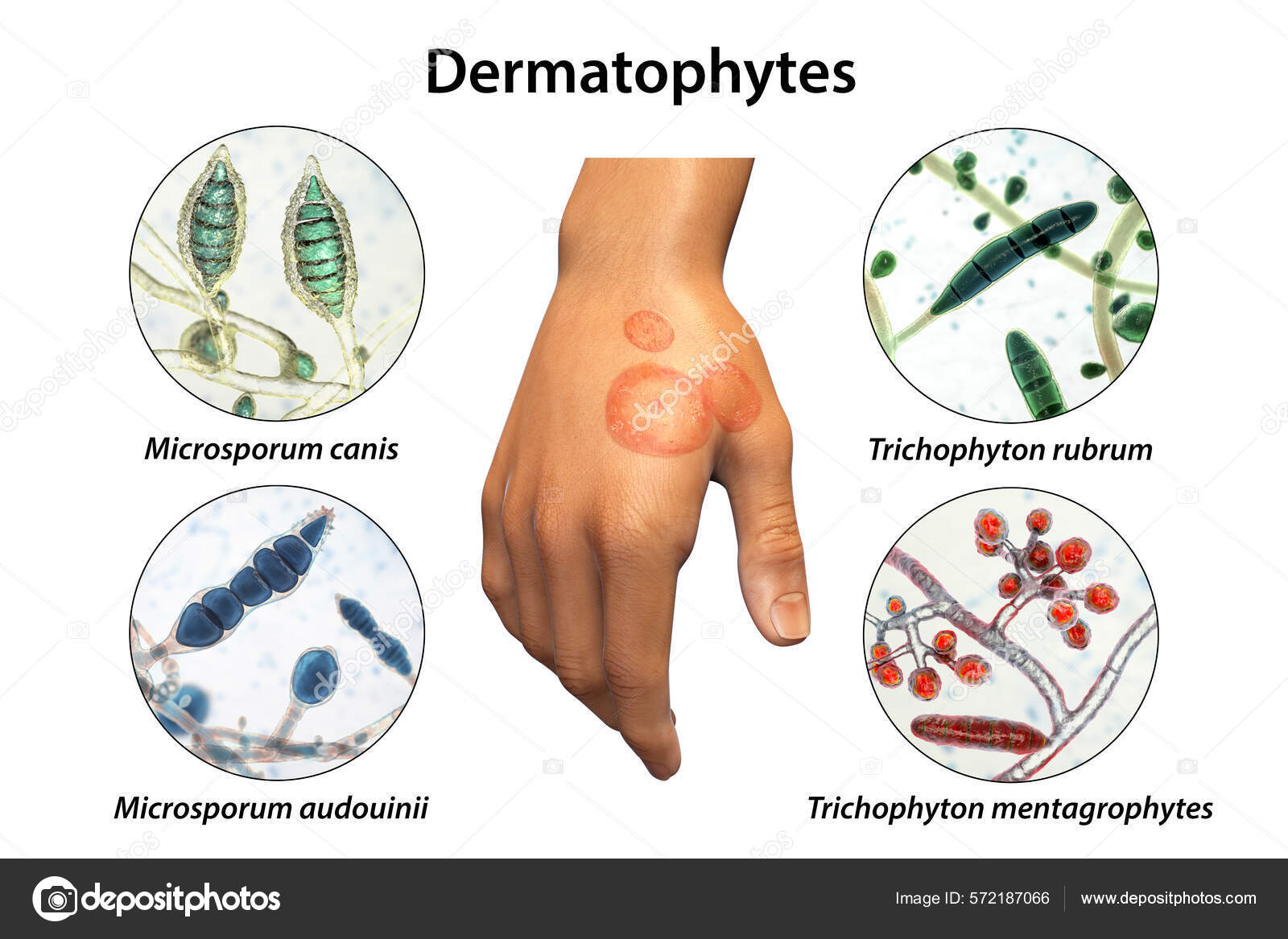 Infeksi Jamur Tangan Cacing Gelang Tinea Manuum Dan Pandangan Dekat ...