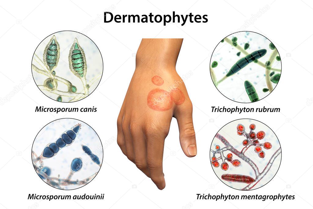 Infección por hongos en la mano. Ringworm, tinea manuum and close-up ...