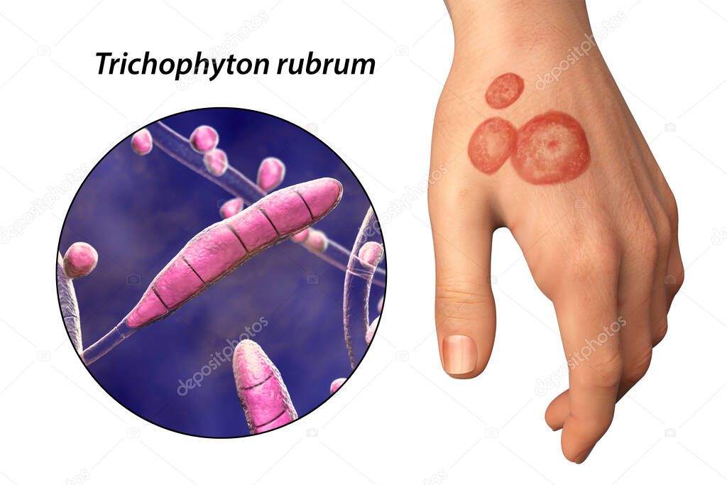 Infección Fúngica En La Mano De Un Hombre Tinea Manuum Y Vista De