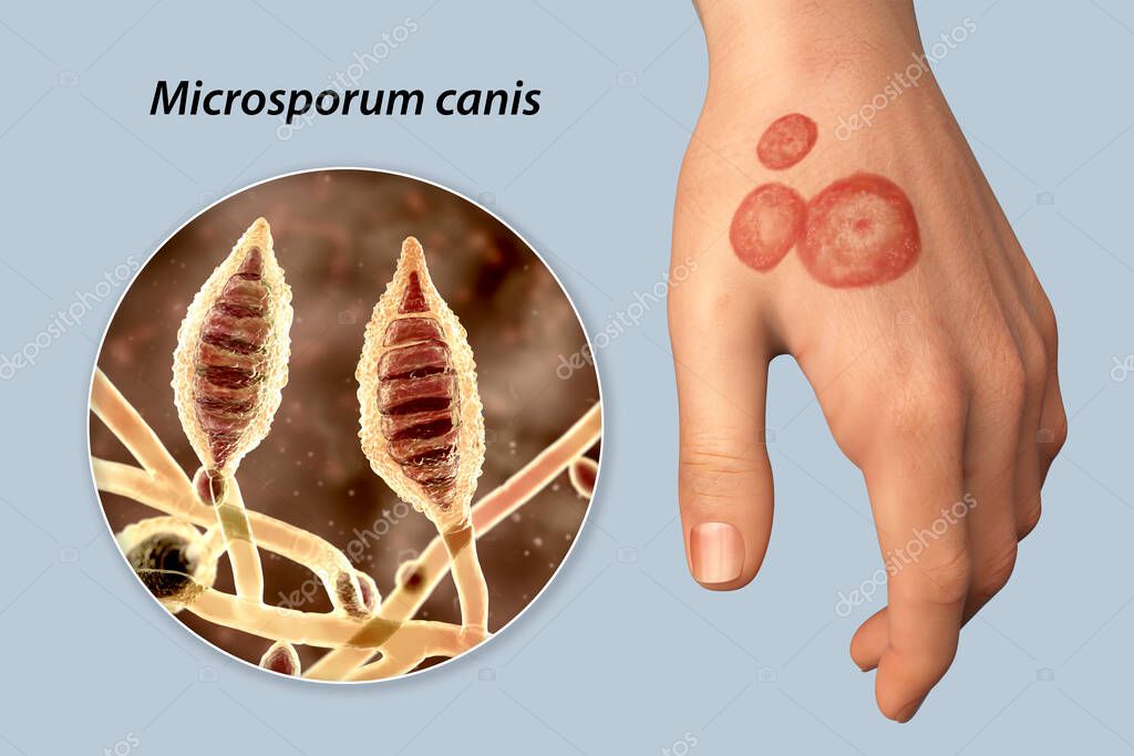 Infección Fúngica En Una Mano Humana Tinea Manuum Y Vista De Cerca De