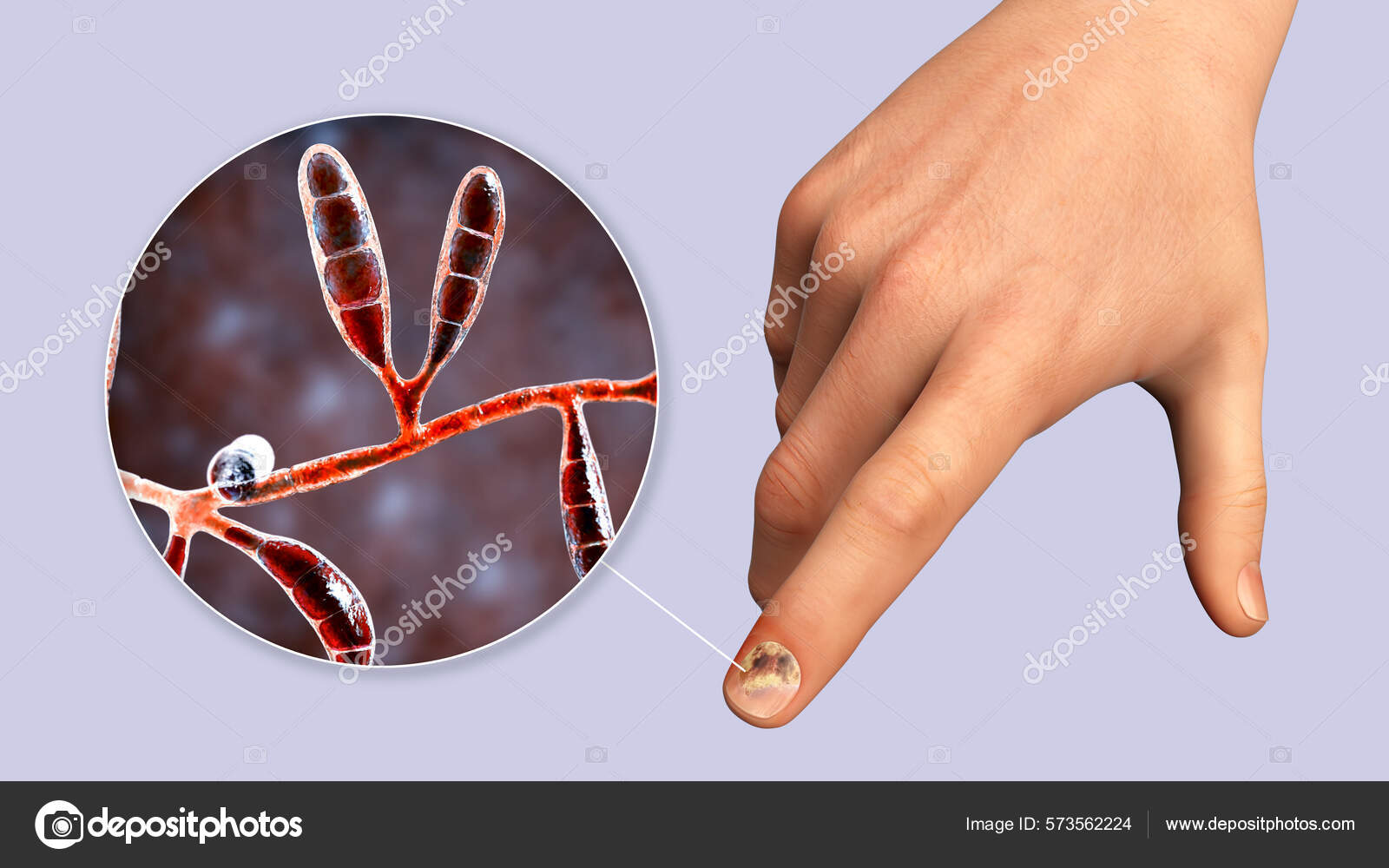 Human Hand Onychomycosis Close View Epidermophyton Floccosum Fungi One ...