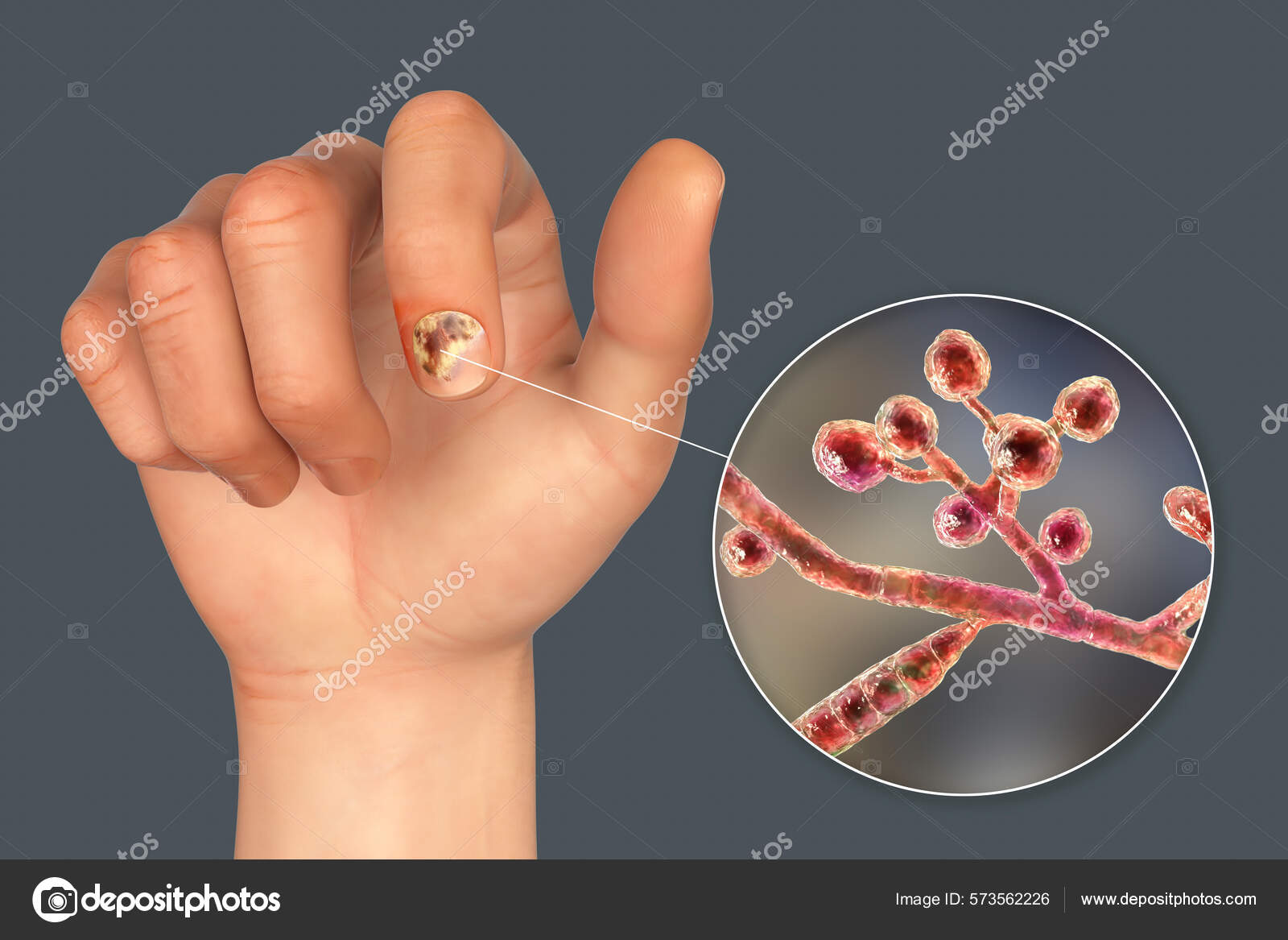 Human Hand Onychomycosis Close View Trichopyton Mentagrophytes Fungi ...