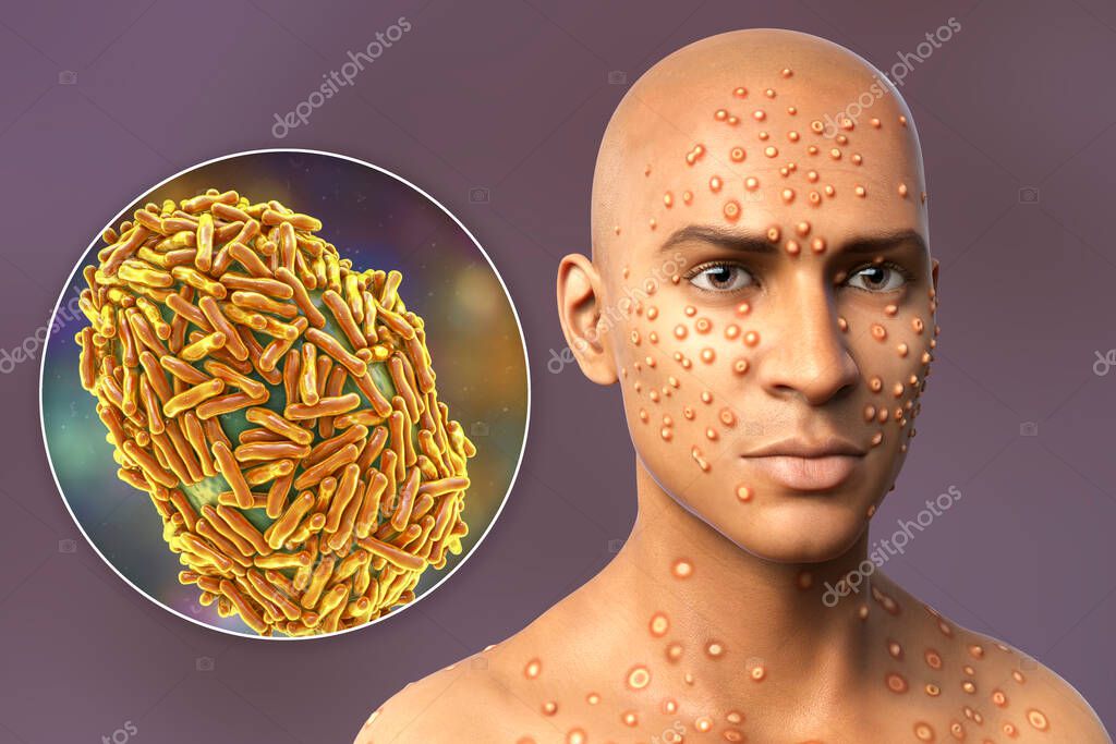 Paciente con varicela y vista de cerca del virus de la varicela ...