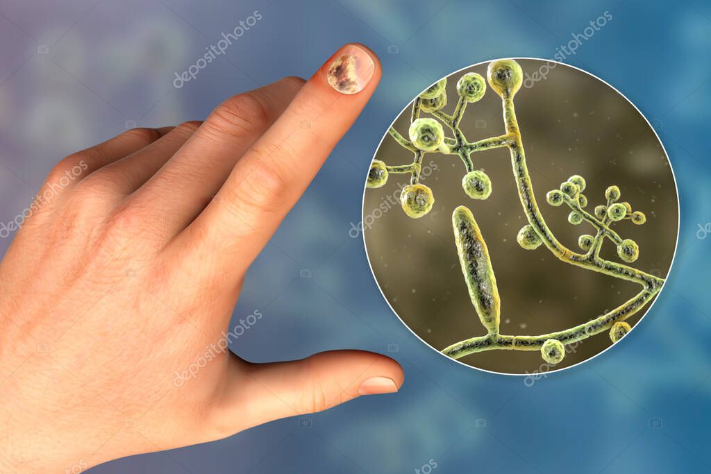 Mano humana con onicomicosis y vista de cerca de hongos Trichopyton ...