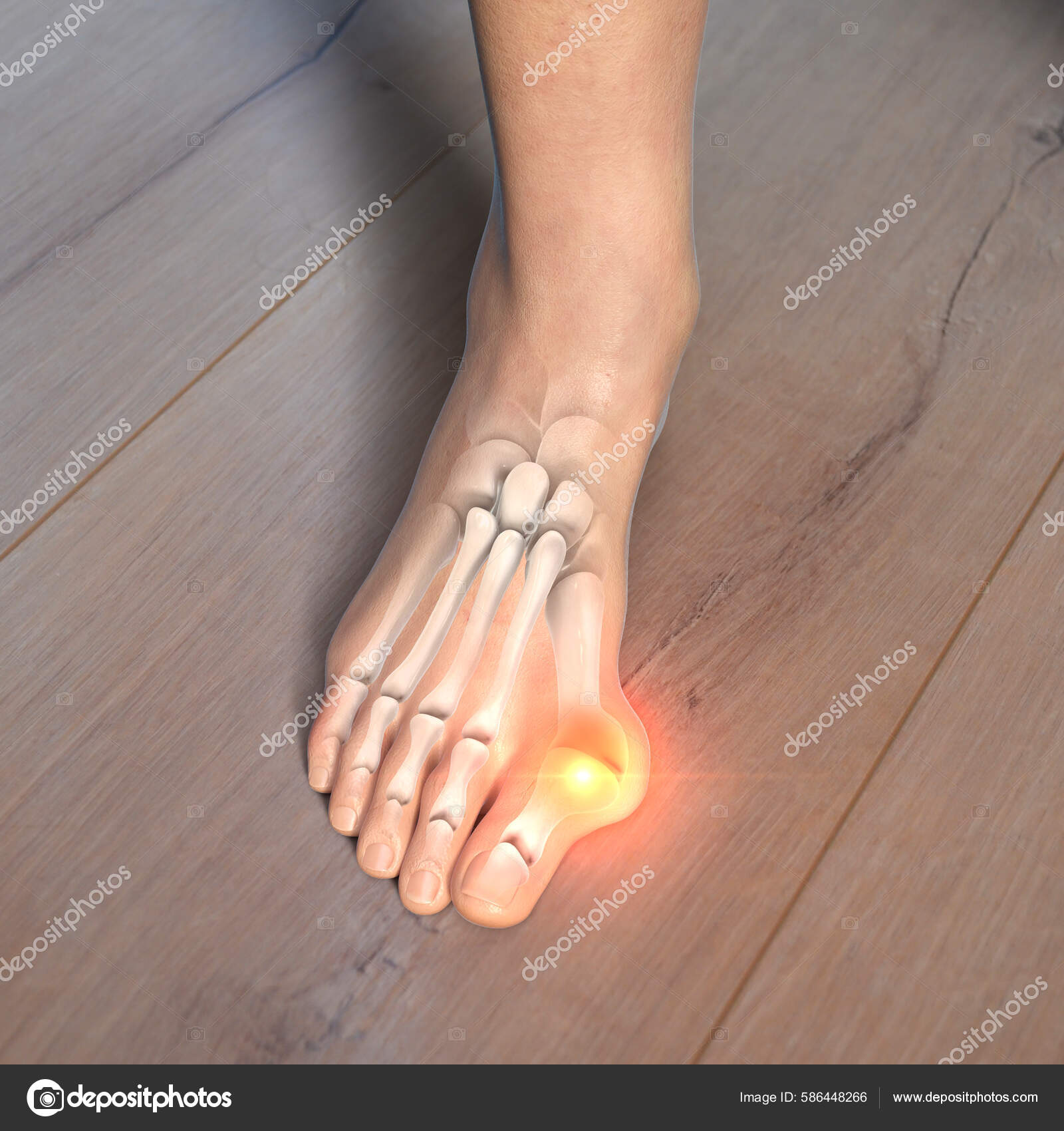 Toe Deformation Also Known Hallux Valgus Bunion Illustration Showing ...