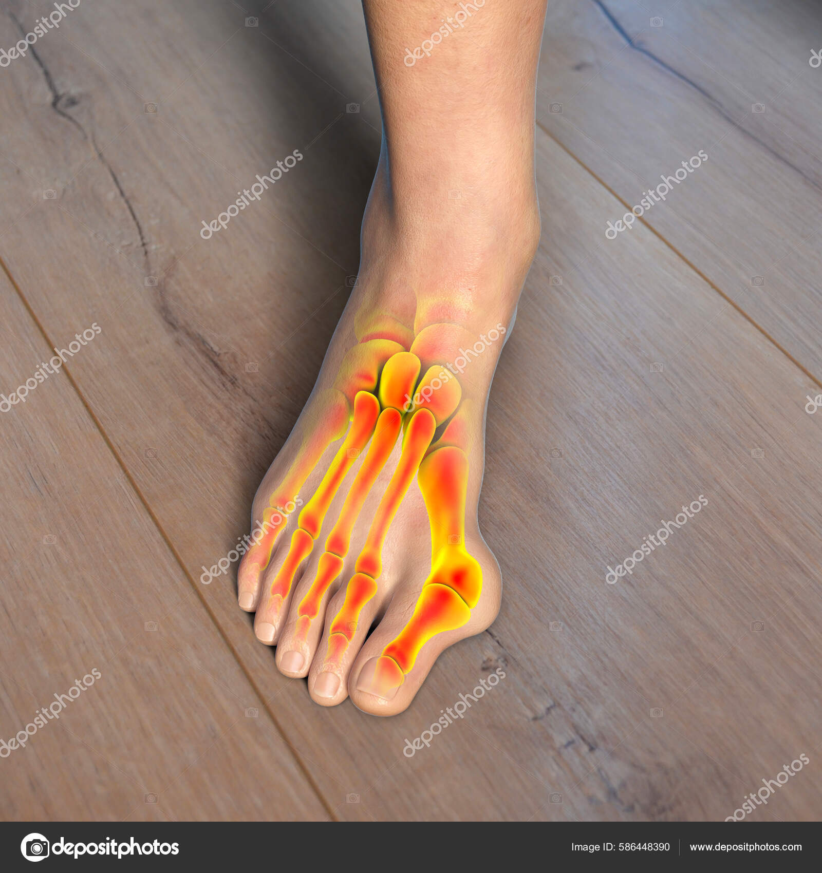 Toe Deformation Also Known Hallux Valgus Bunion Illustration Showing ...