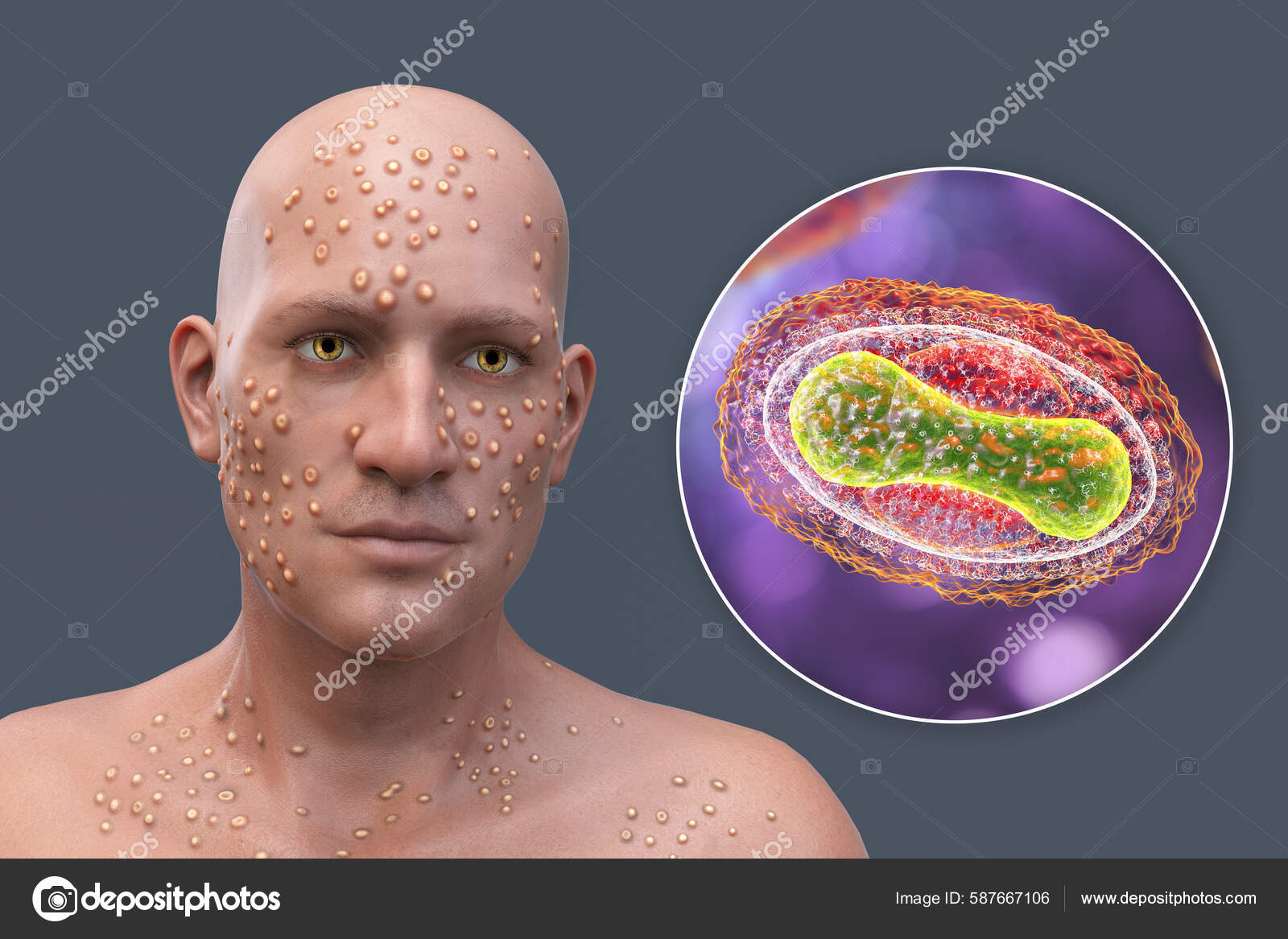 Man Skin Boils Caused Pox Viruses Close View Virus Illustration — Foto ...