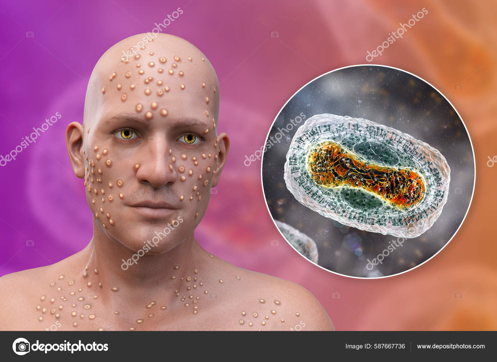 Man Skin Boils Caused Pox Viruses Close View Virus Illustration — Stock ...