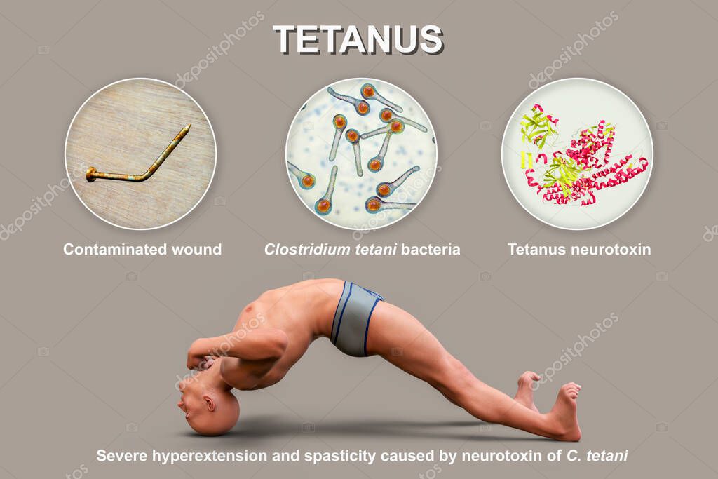 Mechanism of tetanus disease, 3D illustration. A skin wound is ... Mechanism of tetanus disease, 3D illustration. A skin wound is ...