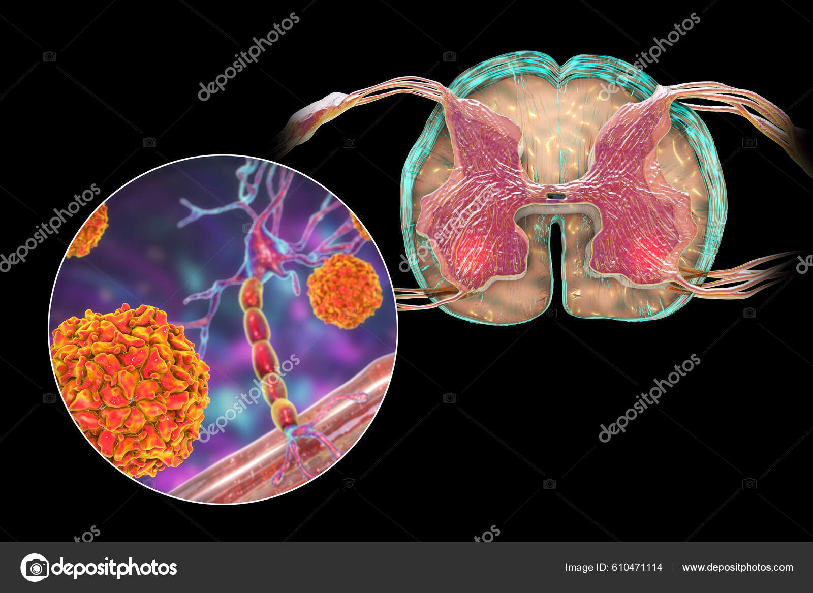 Mechanism Paralytic Polio Disease Polio Viruses Affecting Motor Neurons ...