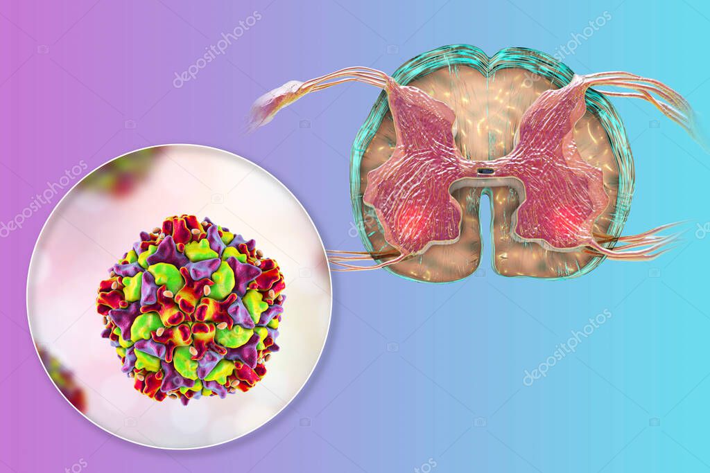Mecanismo de la poliomielitis paralítica. Virus de la poliomielitis que ...