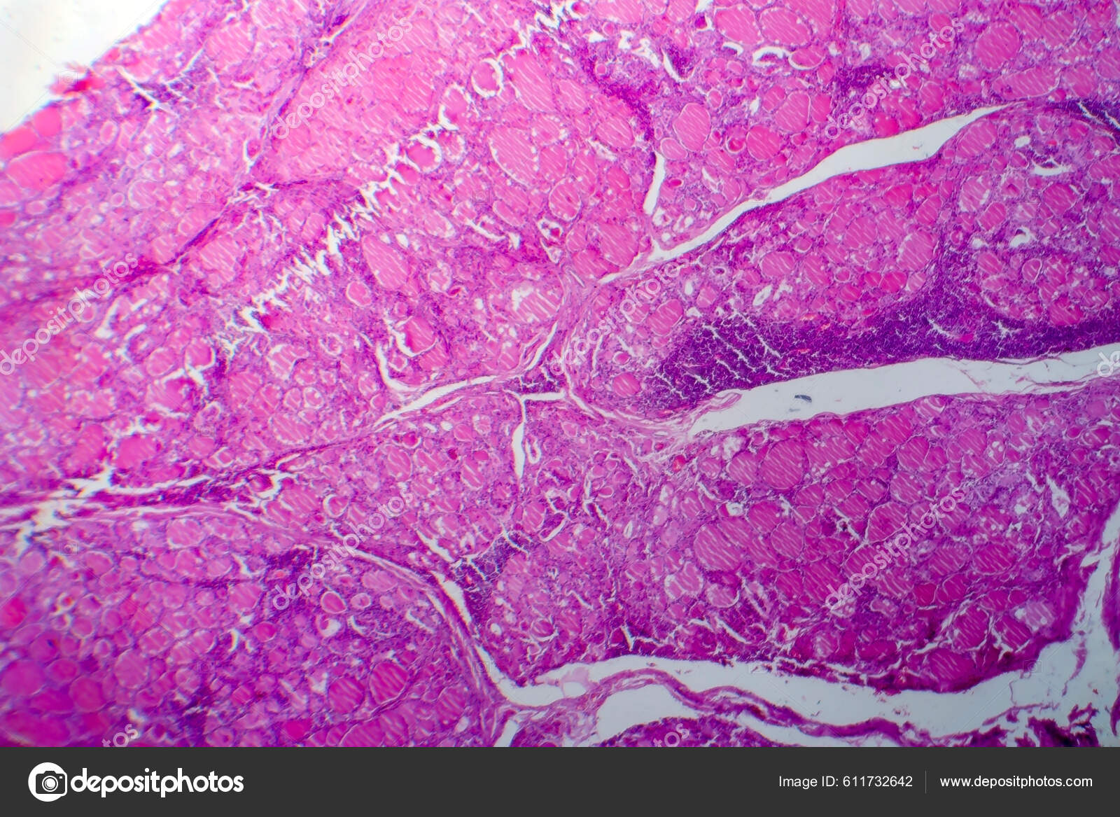 Bocio Simple Micrografía Ligera Foto Bajo Microscopio Ampliación ...