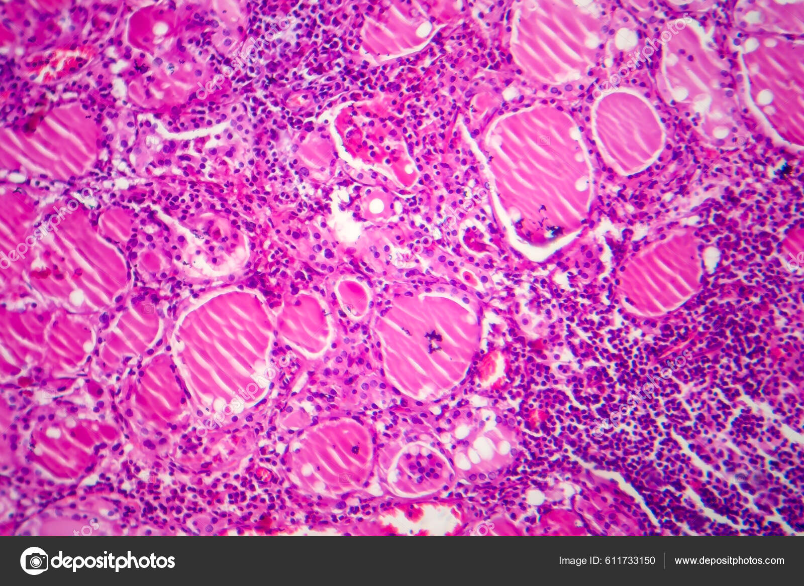 Simple Goiter Light Micrograph Photo Microscope Enlargement Thyroid ...