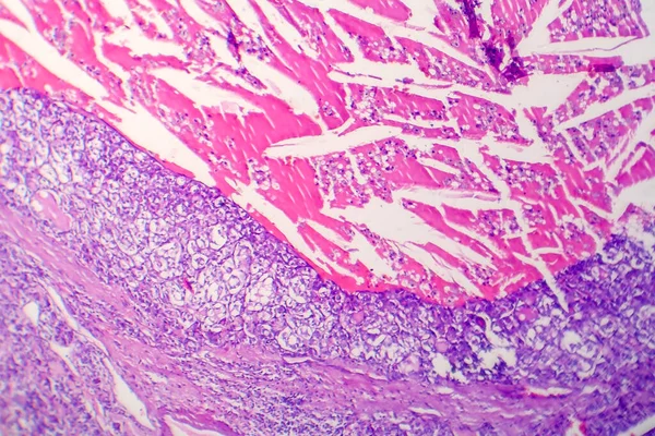 Meningioma Slow Growing Tumor Forms Meninges Light Micrograph Photo ...