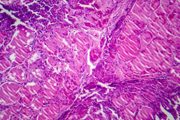 Simple Goiter Light Micrograph Photo Microscope Enlargement Thyroid ...