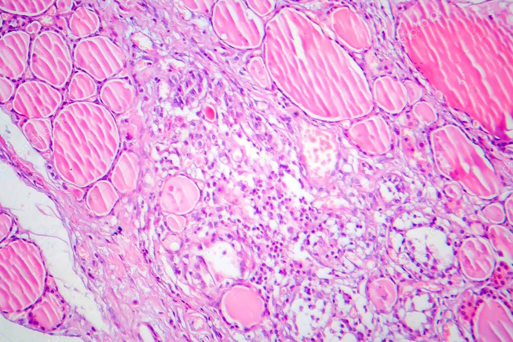 Tiroiditis fibrosa, micrografía ligera, foto bajo el microscopio ...