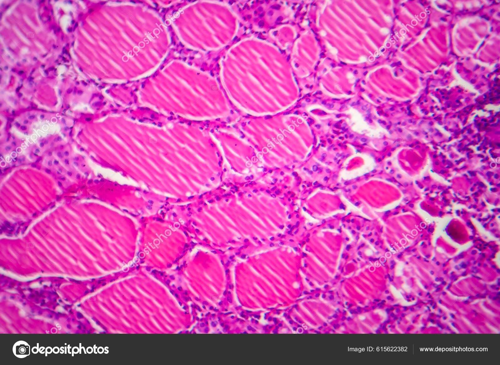 Bócio Simples Micrografia Luz Foto Sob Microscópio Alargamento Glândula ...