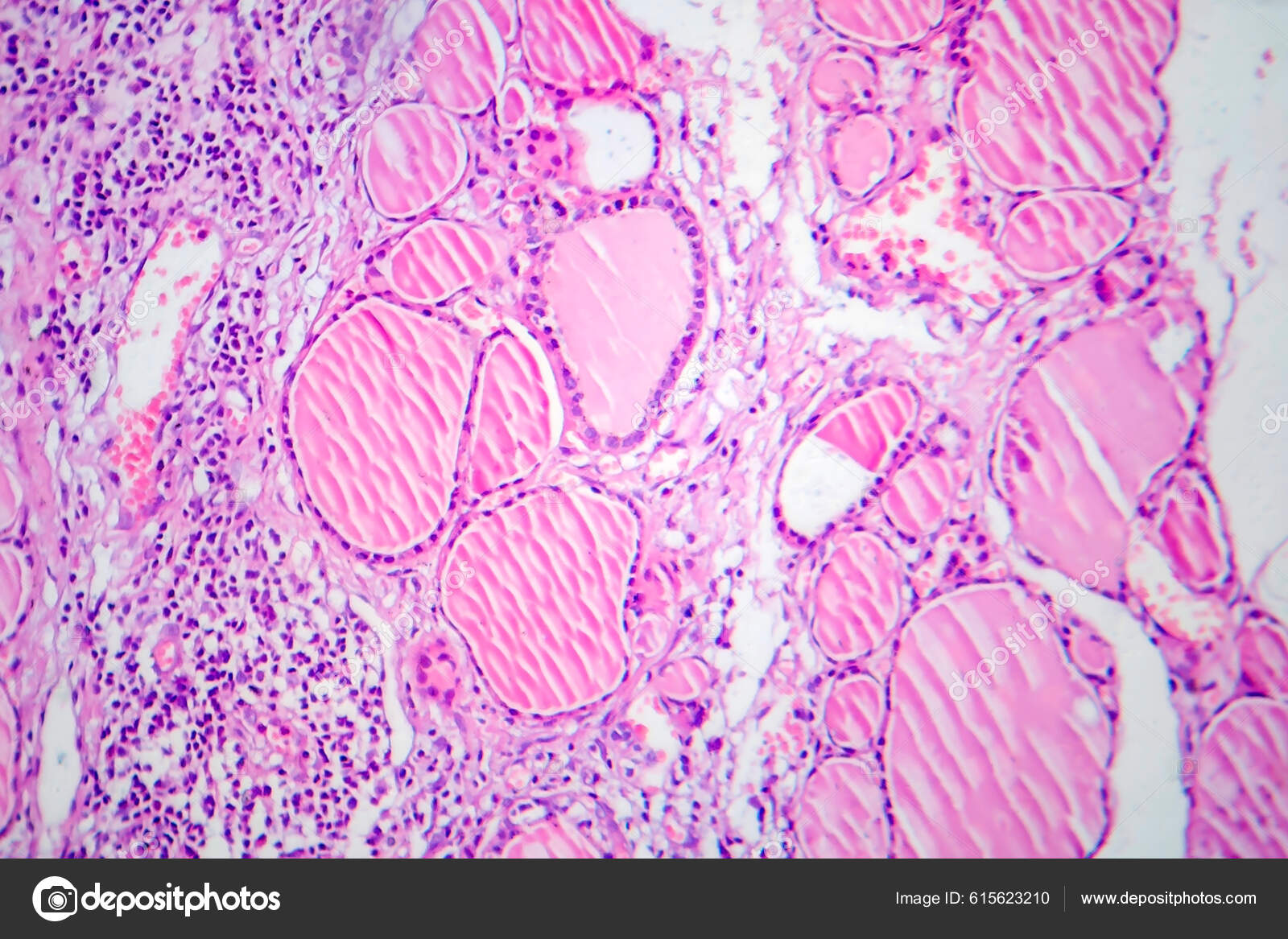 Fibrous Thyroiditis Light Micrograph Photo Microscope Disease ...
