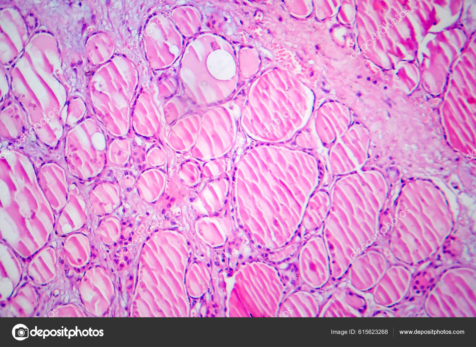 Fibrous Thyroiditis Light Micrograph Photo Microscope Disease ...