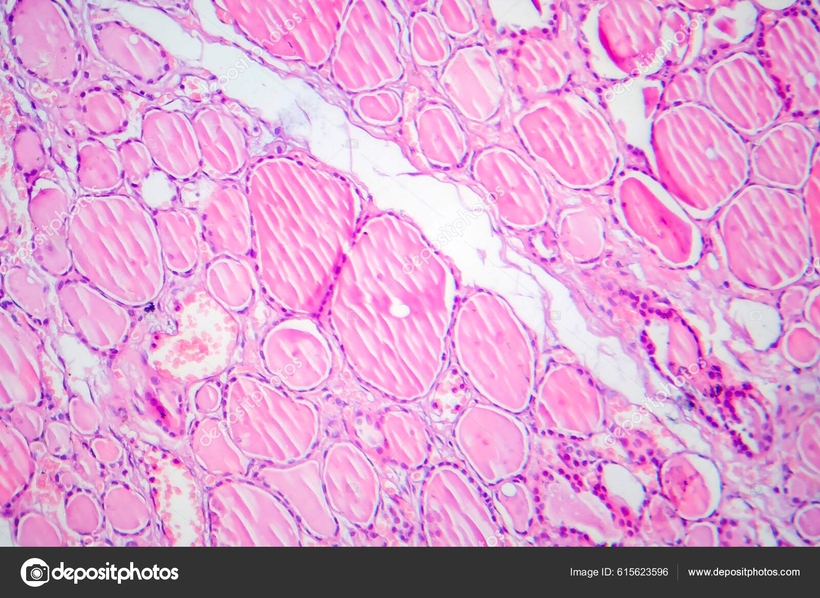 Fibrous Thyroiditis Light Micrograph Photo Microscope Disease ...