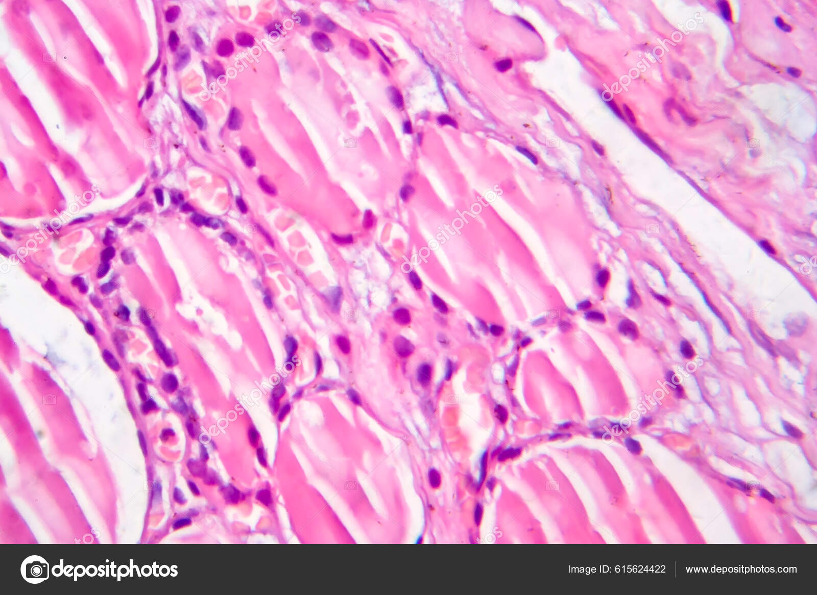 Fibrous Thyroiditis Light Micrograph Photo Microscope Disease ...