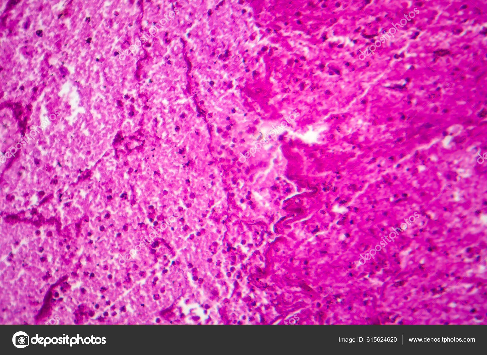 Purulent Meningitis Light Micrograph Photo Microscope — Stock Photo ...