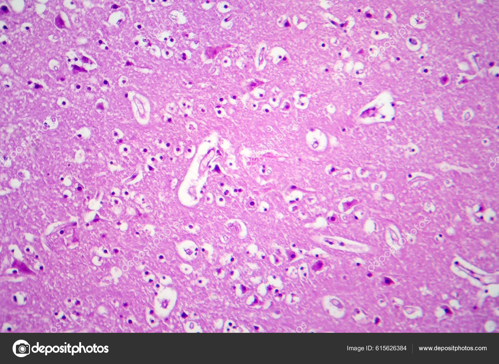 Histopathology Japanese Encephalitis Light Micrograph Photo Microscope ... Histopathology Japanese Encephalitis Light Micrograph Photo Microscope ...