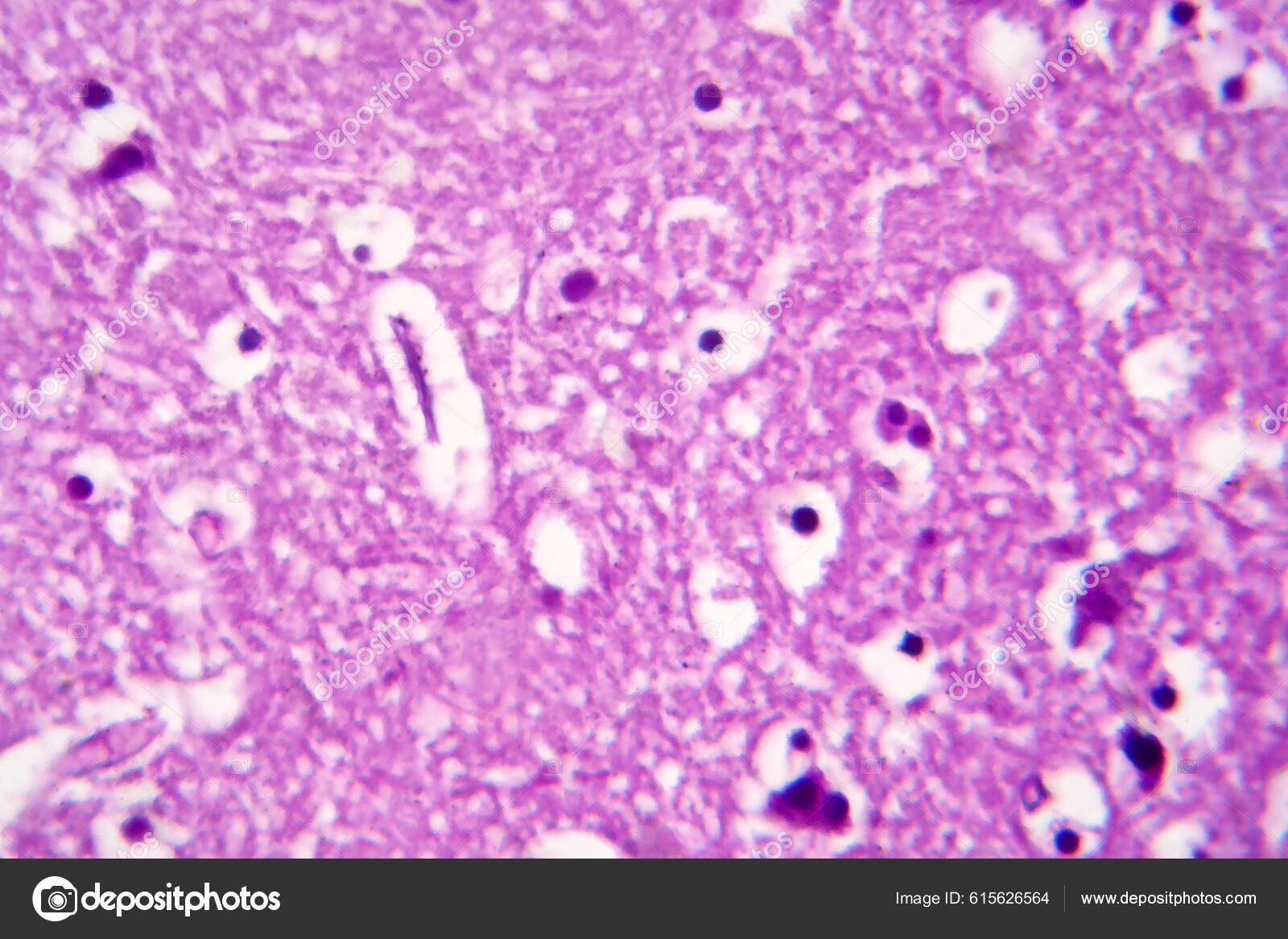 Histopathology Japanese Encephalitis Light Micrograph Photo Microscope ...