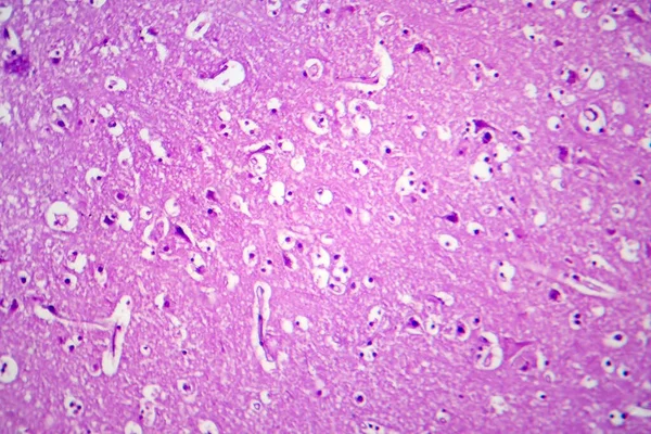 Histopathology Japanese Encephalitis Light Micrograph Photo Microscope ...