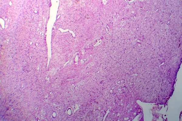 Purulent Meningitis Light Micrograph Photo Microscope — Stock Photo ...