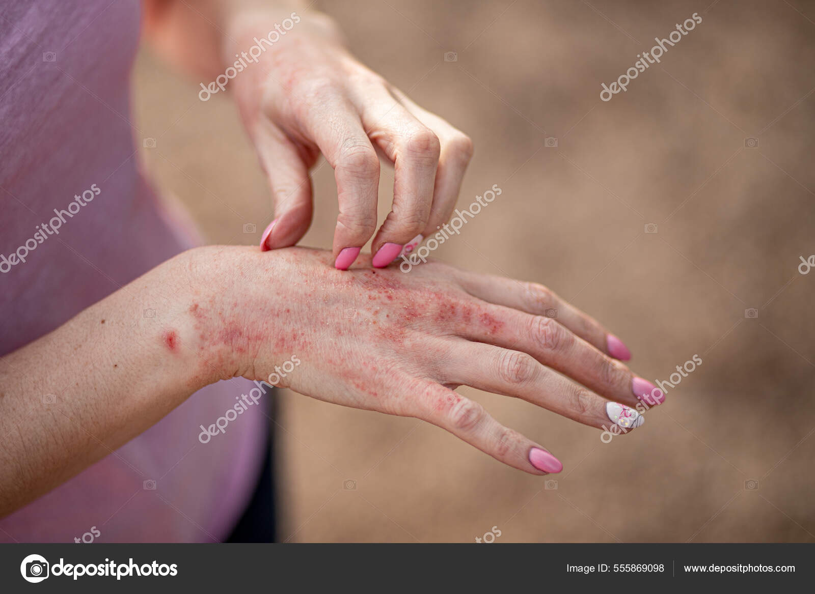 Dermatitis Eccema Las Manos Los Pies Manchas Rojas Piel Piel — Foto de ...