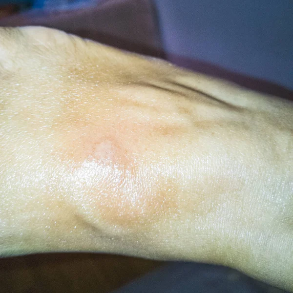 Millipede bite Stock Photos, Royalty Free Millipede bite Images ...