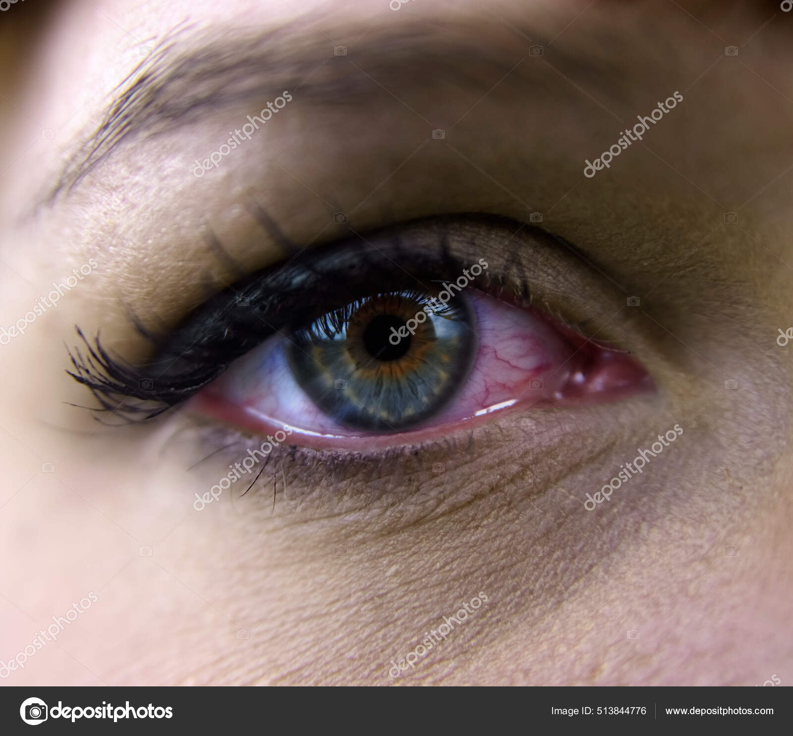 Young Woman Burst Blood Vessel Eye Closeup Image Stock Photo by ...