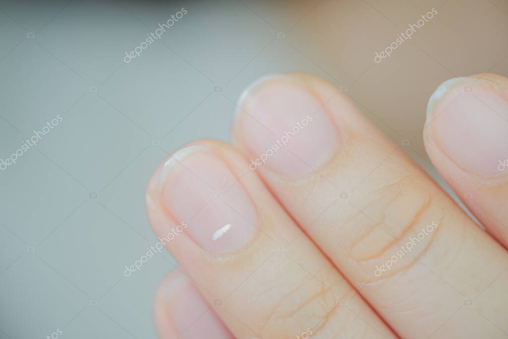 Manchas blancas en las uñas de los dedos llamadas leuconiquia revelan ...