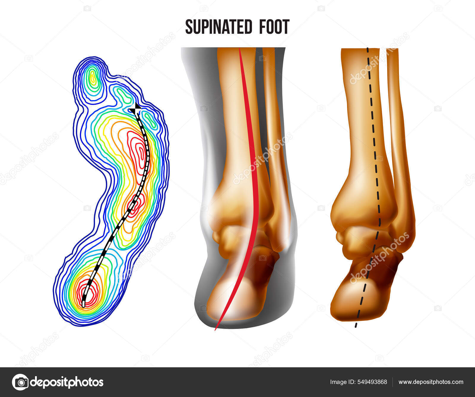 Supinated foot, arch deformation, bottom and back view . Foot weight ...