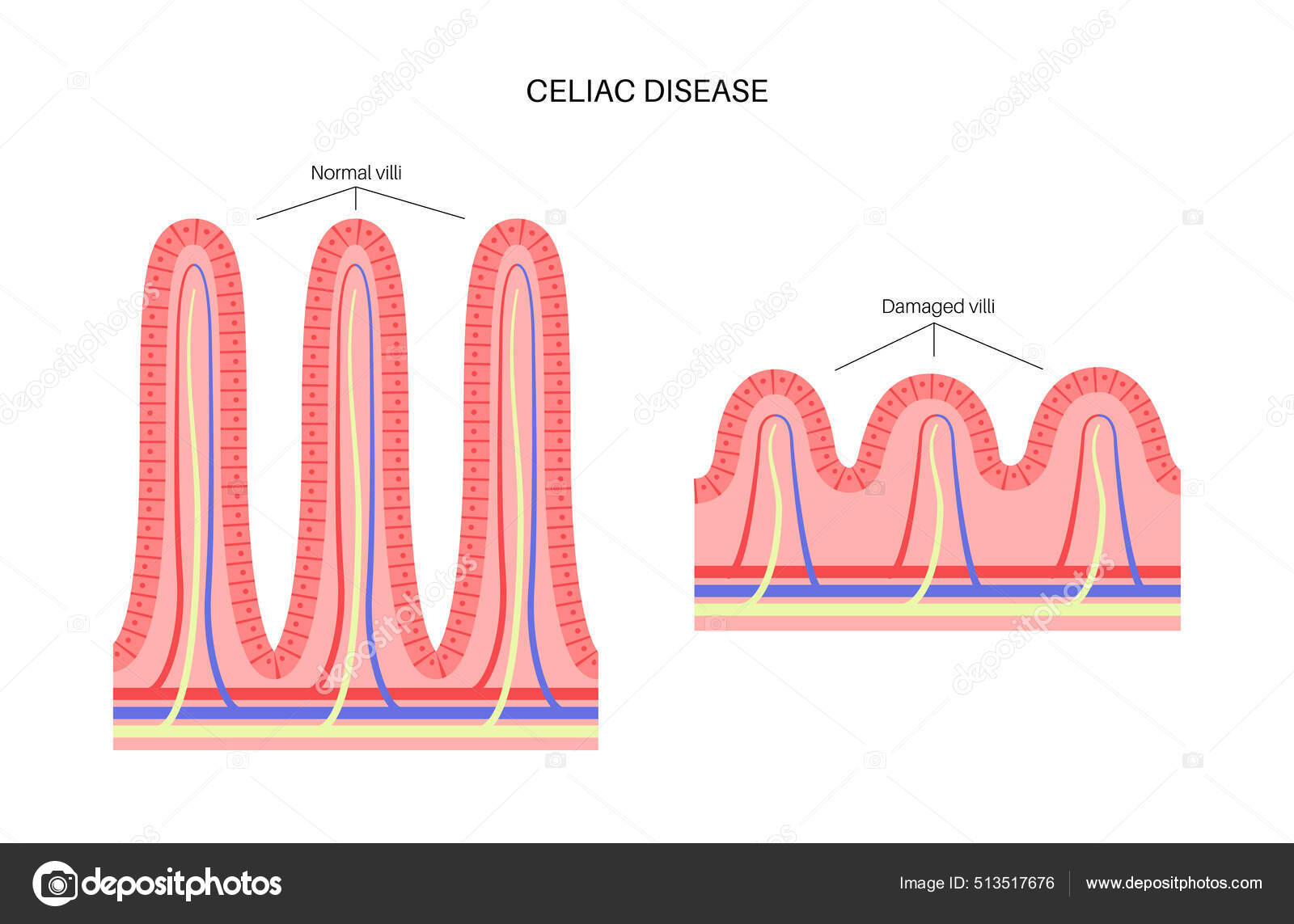 Cøliaki betændelse Stock-vektor af ©Pikovit 513517676