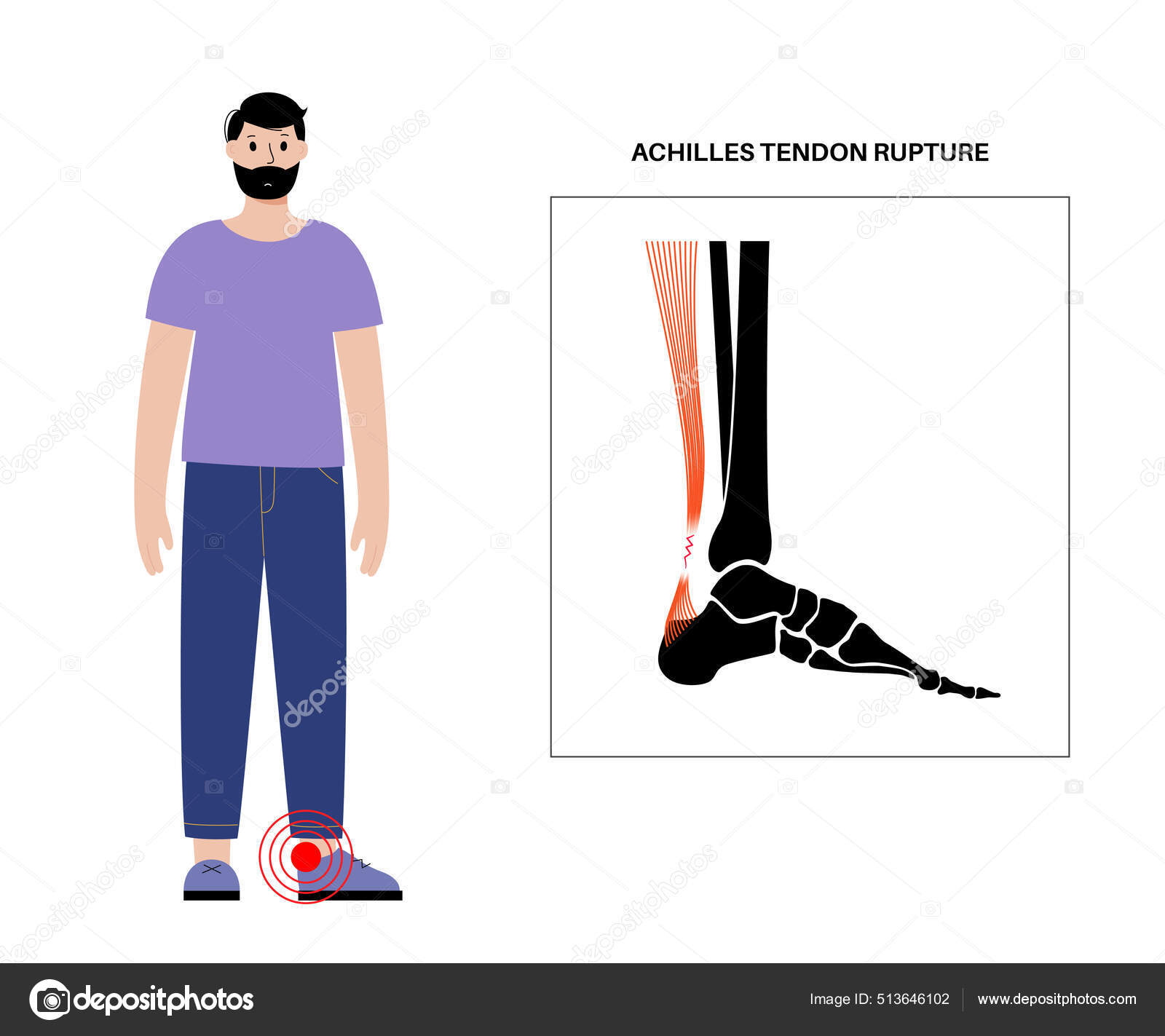 Achilles tendon injury Stock Vector by ©Pikovit 513646102