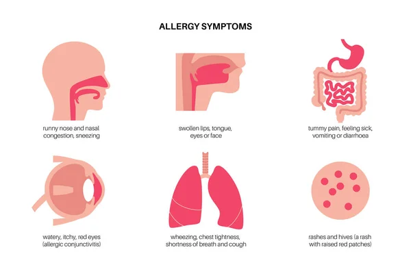 Allergic Rhinitis Poster