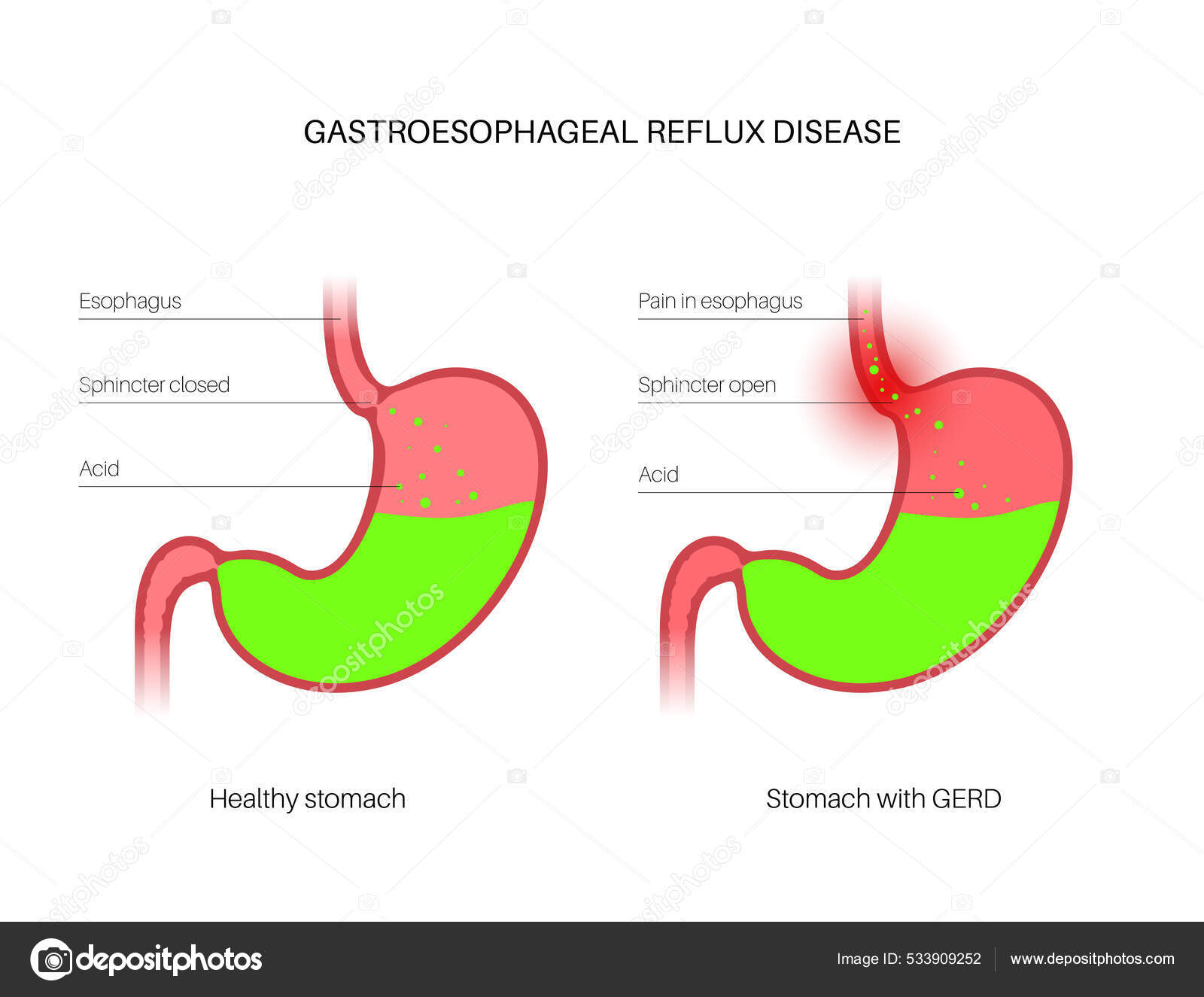 Gastroesophageal reflux disease Stock Vector by ©Pikovit 533909252
