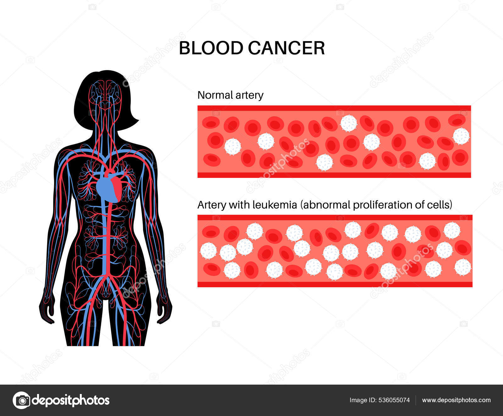 Leukemia cancer disease Stock Vector Image by ©Pikovit #536055074