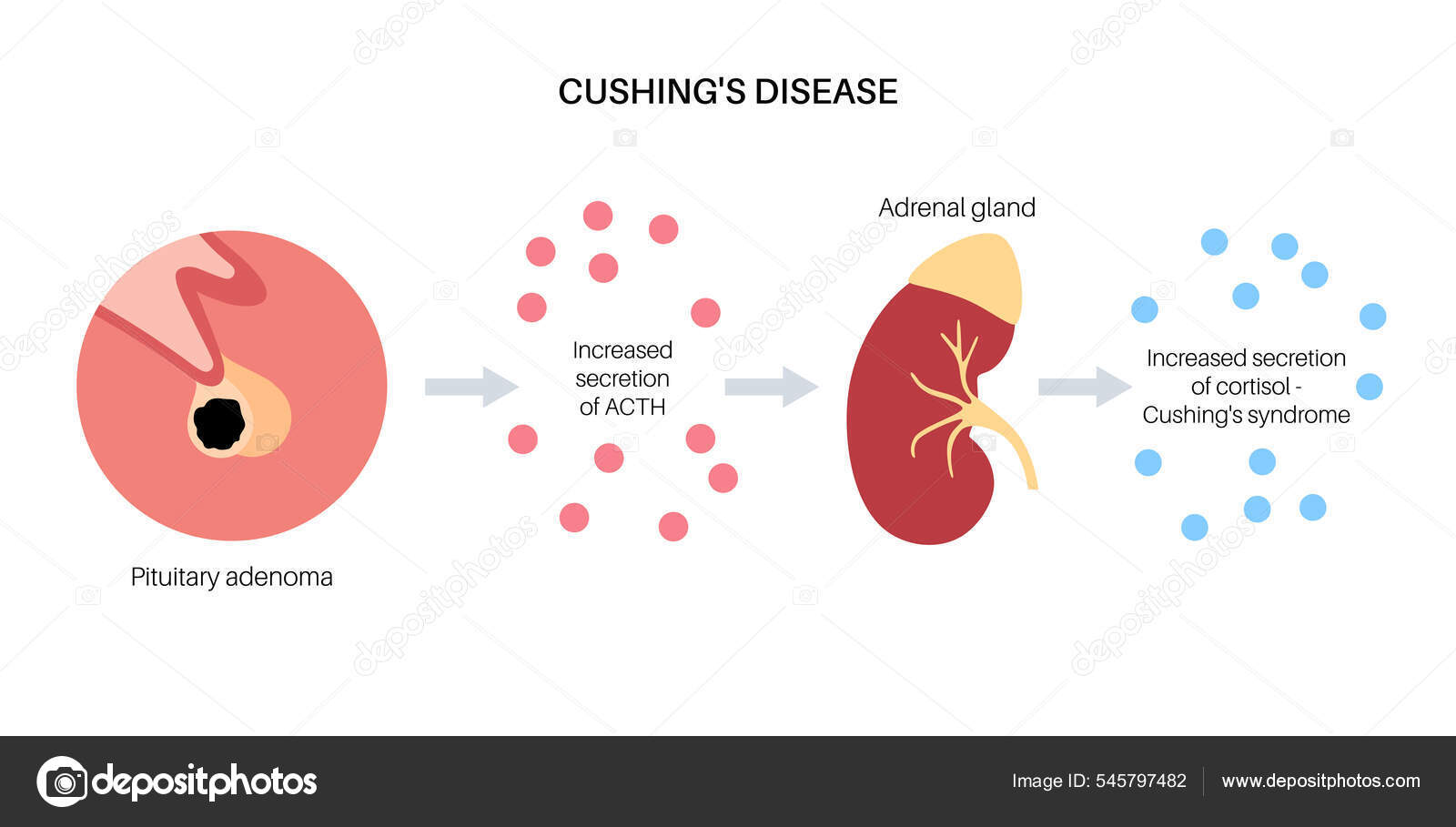 Cushing Desease poster Stock Vector by ©Pikovit 545797482