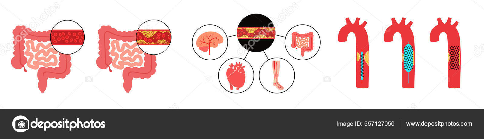 Types of ishemia Stock Vector Image by ©Pikovit #557127050